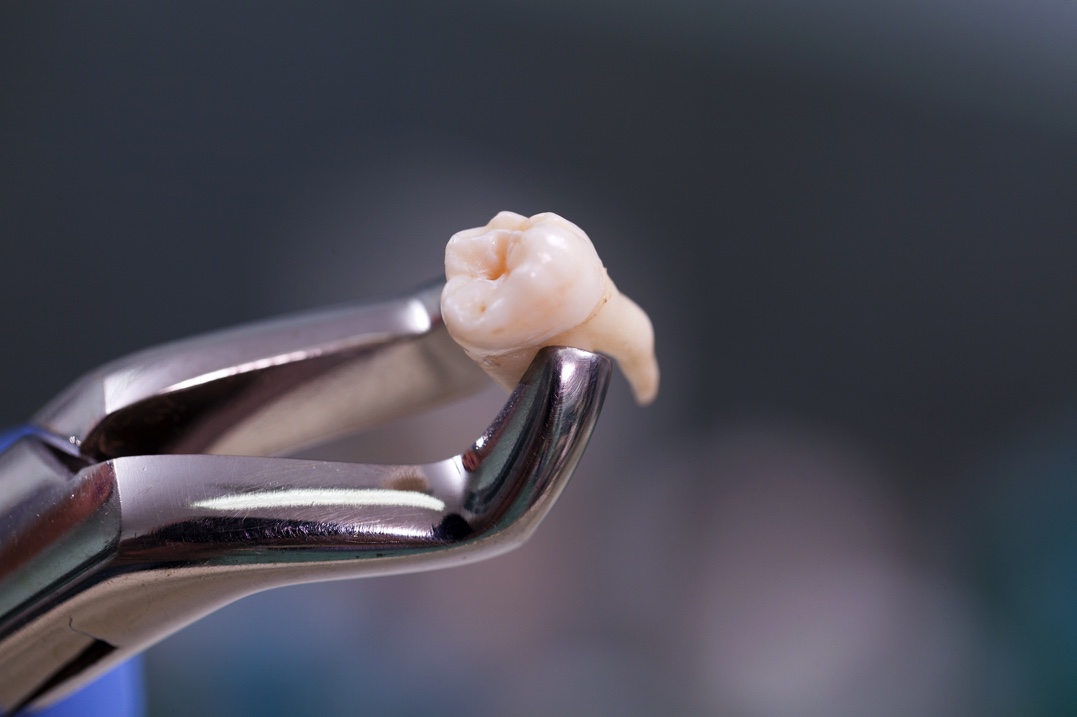 Wisdom Teeth Recovery Time Asheville | John White, DDS